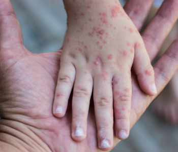 Qu’est-ce que la rubéole, et comment se transmet-elle ? | La Boîte Rose